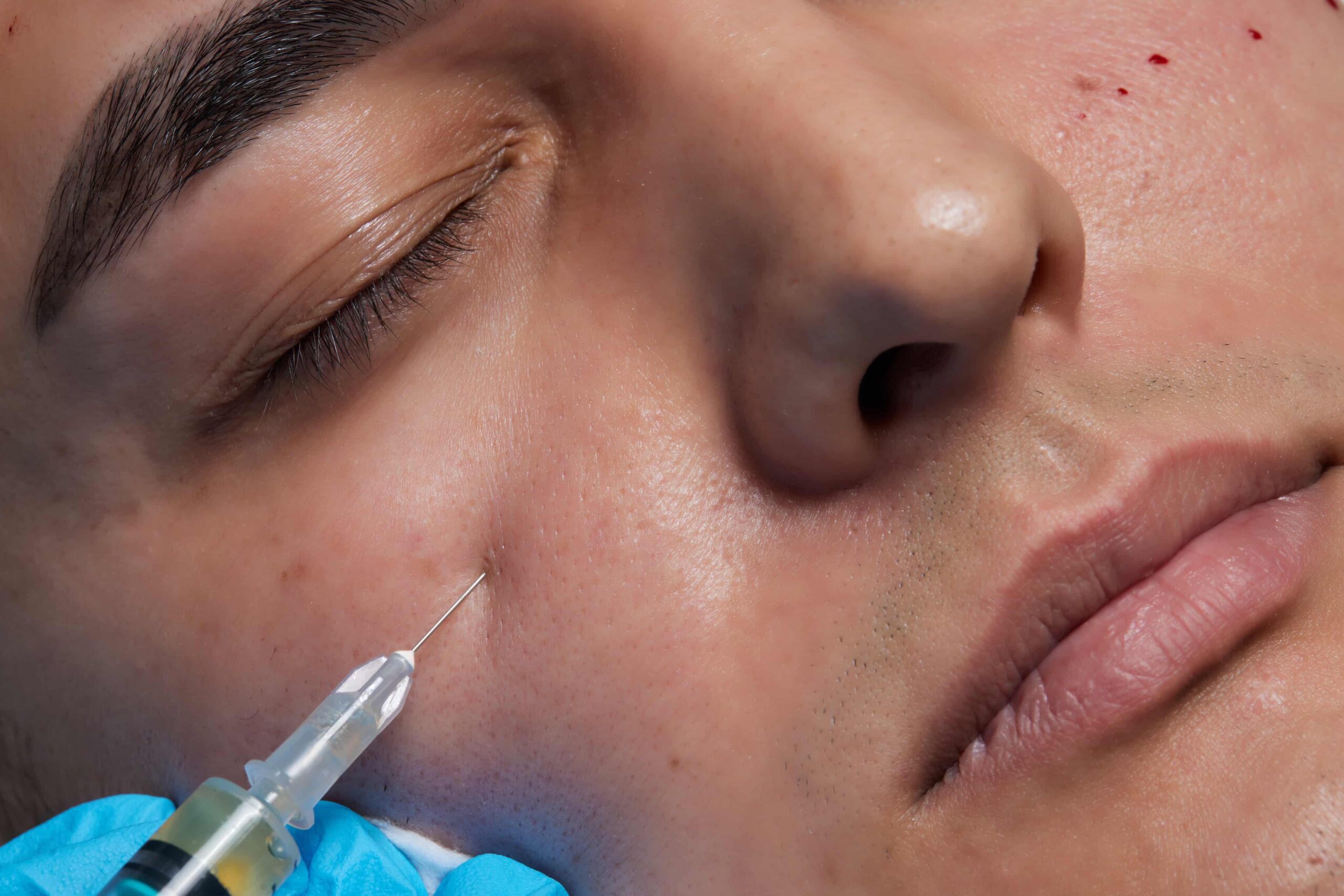 PRF/PRP with Microneedling - Aesthetics HQ