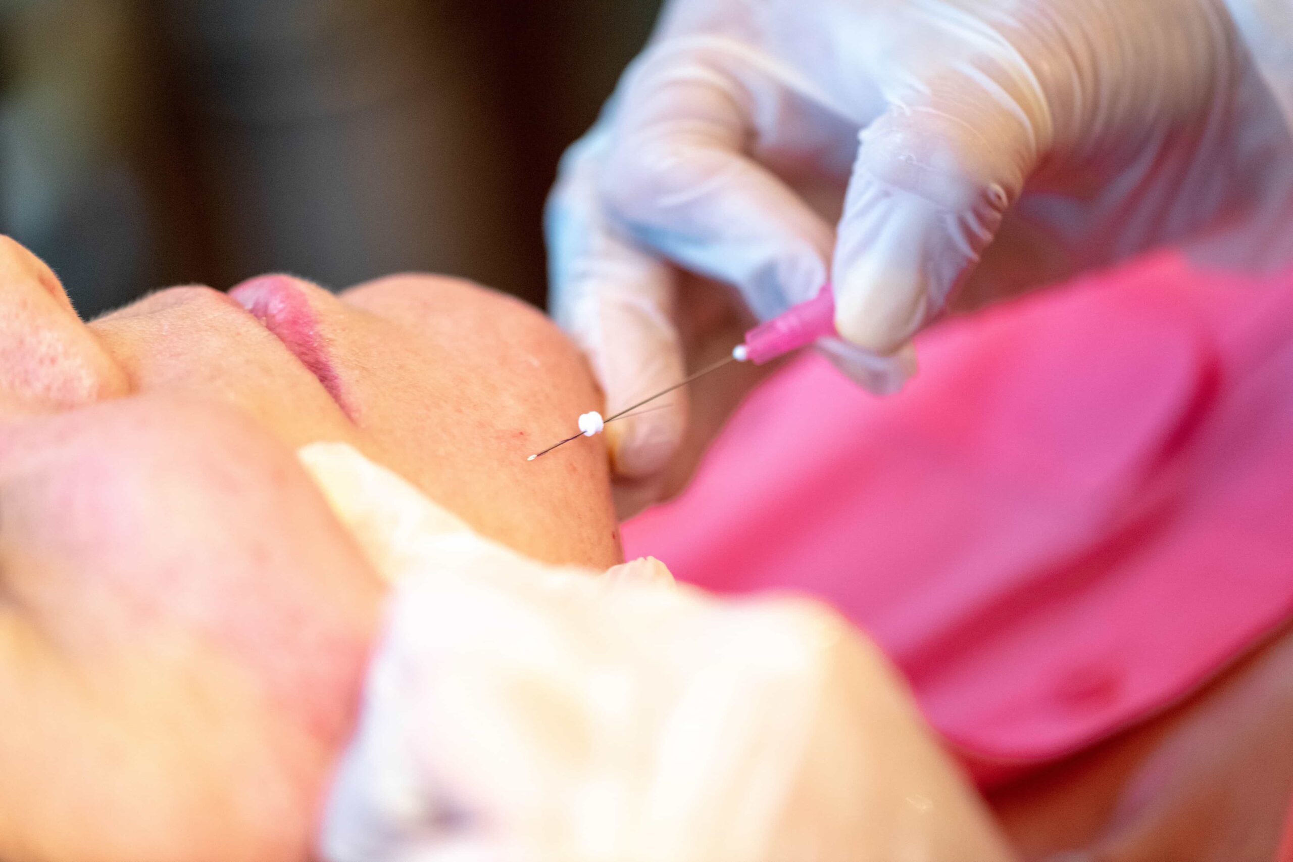 PDO Smooth Threads - Aesthetics HQ